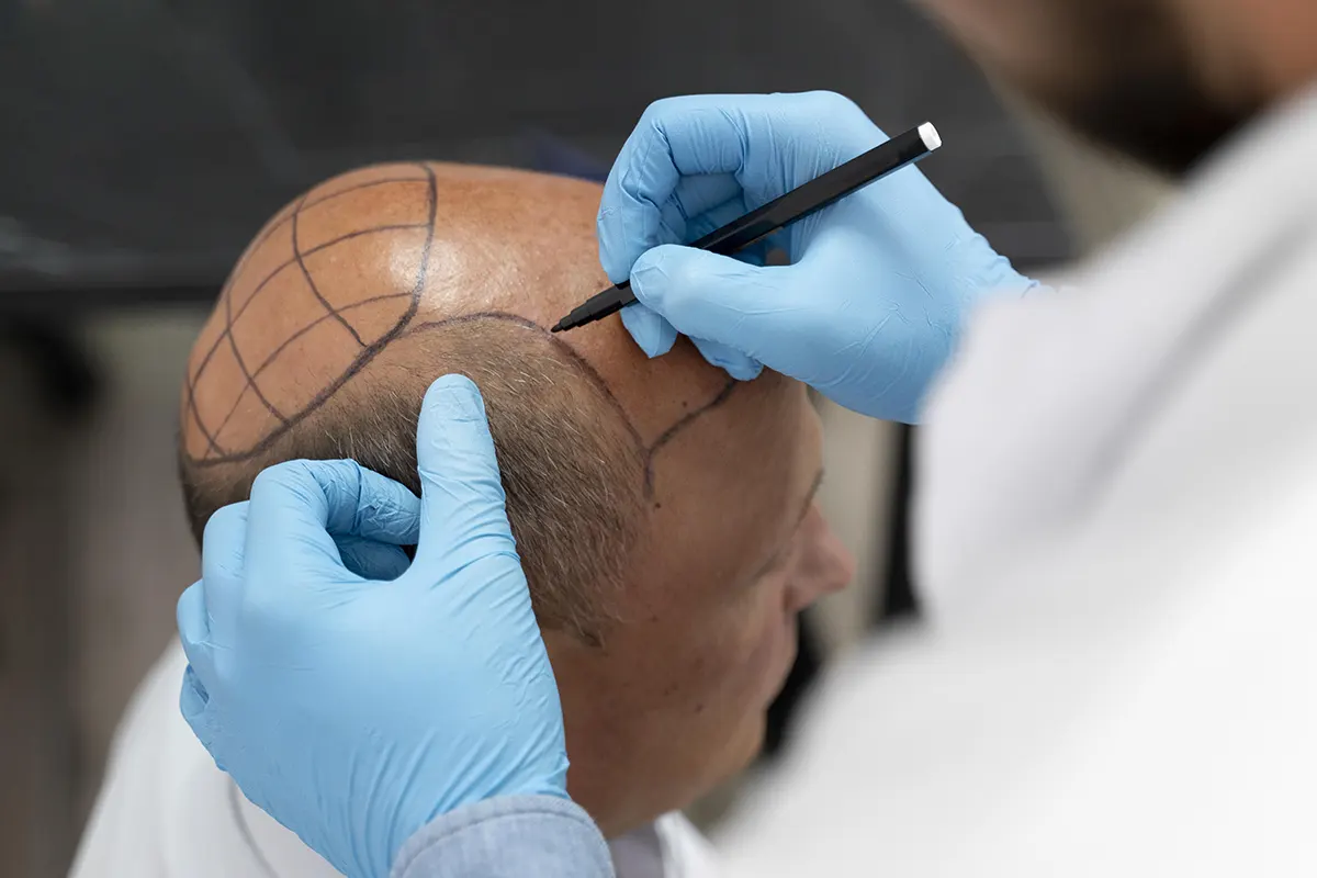 Hair Transplantation vs. DHI: Which is Best for You?